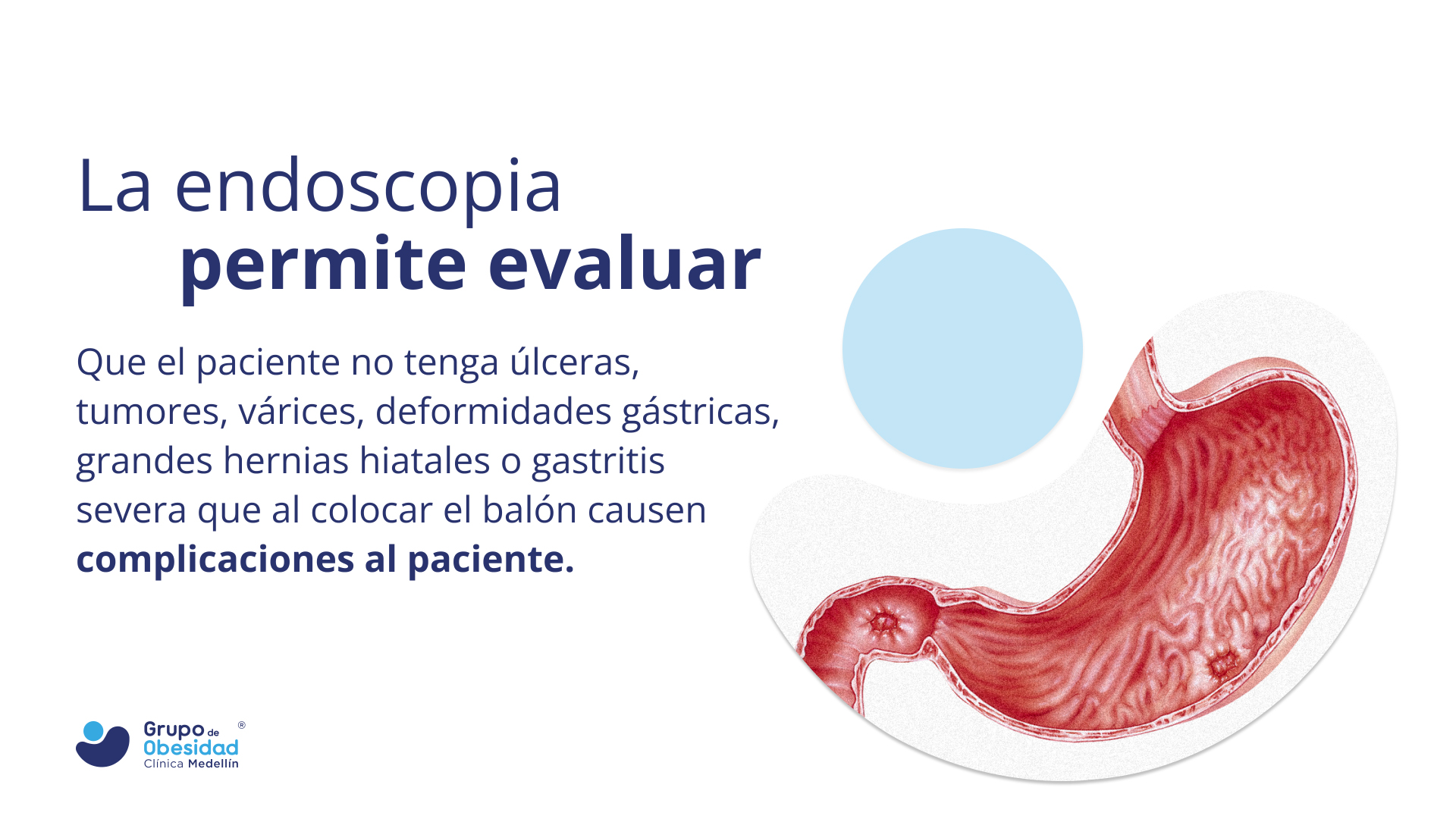 Colocación del Balón Gástrico por Endoscopia