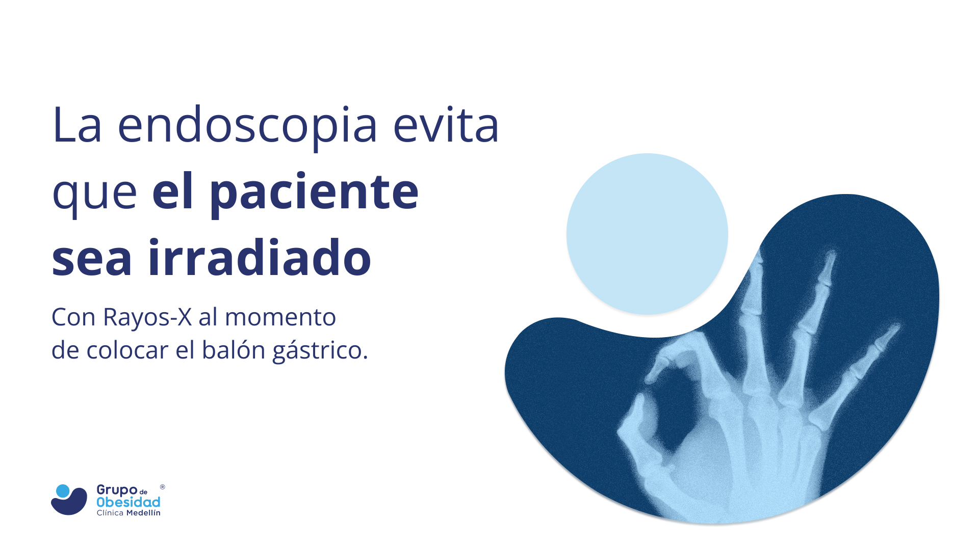 Colocación del Balón Gástrico por Endoscopia