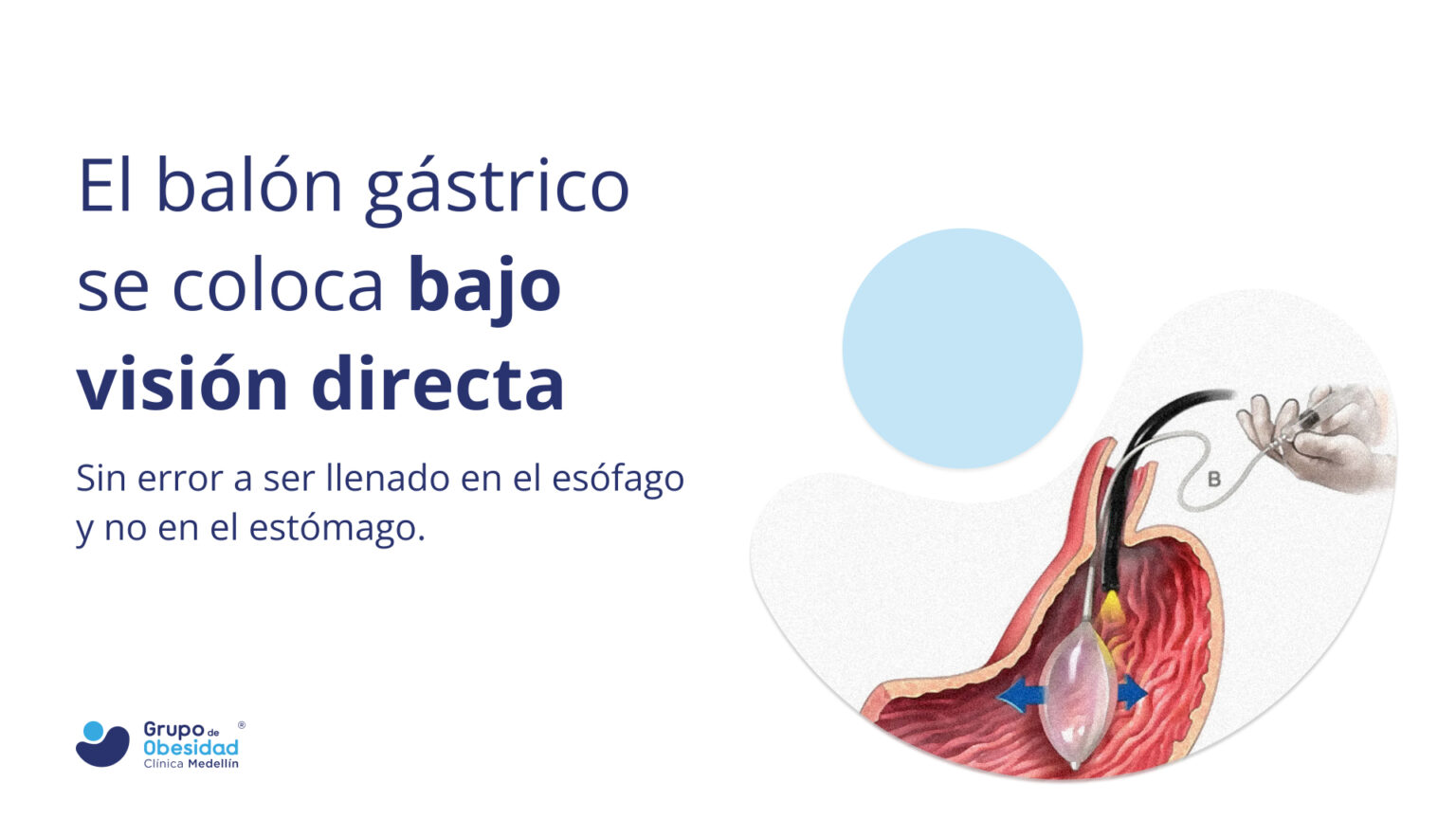 Colocación del Balón Gástrico por Endoscopia
