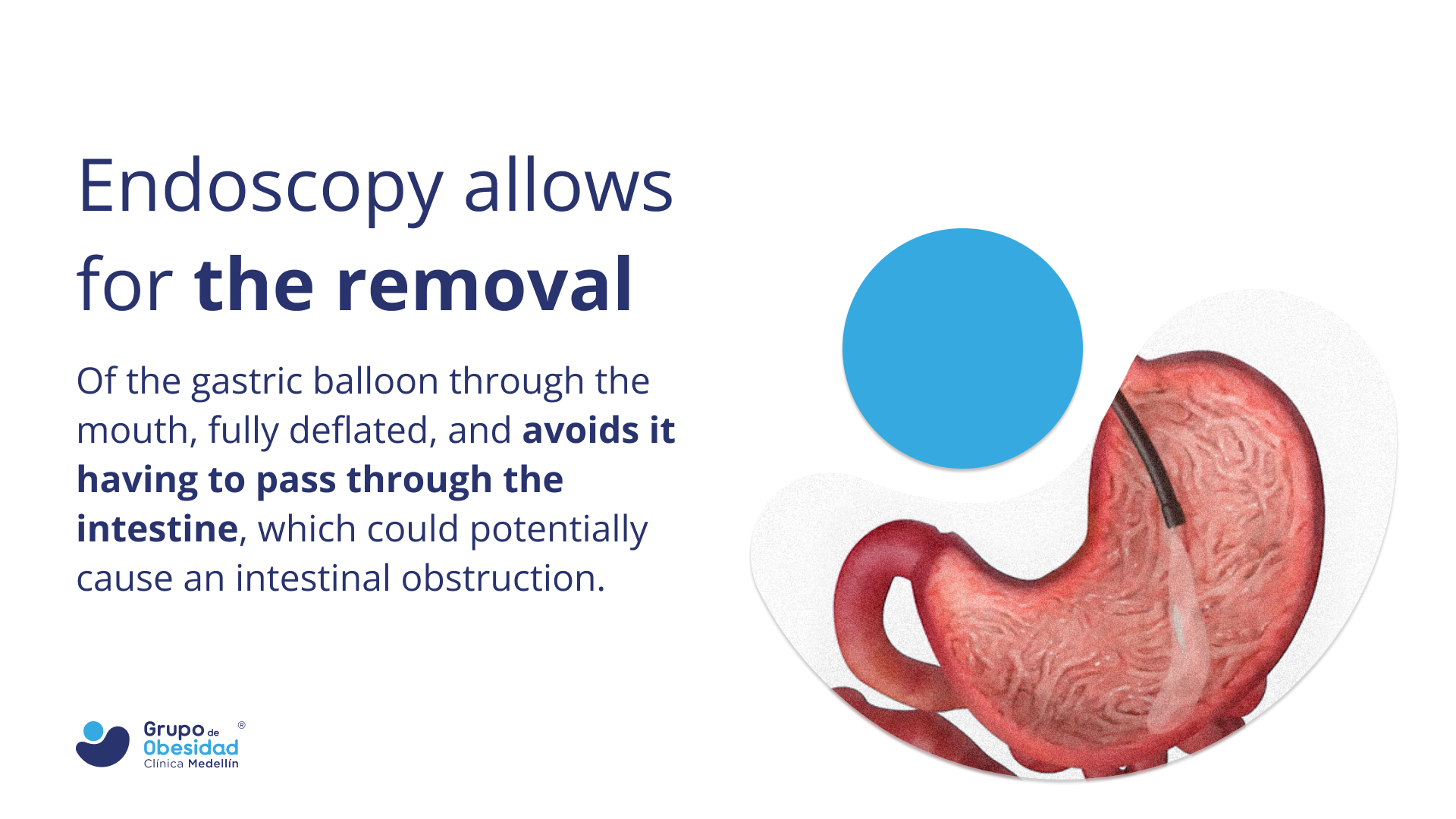The Gastric Balloon Placed via Endoscopy